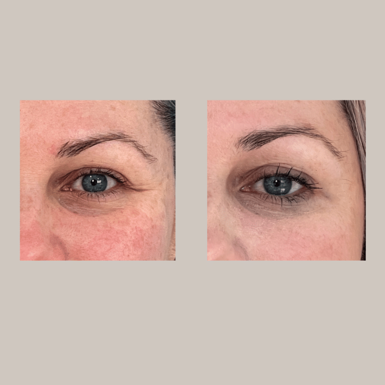 Botox – Lennox Aesthetics